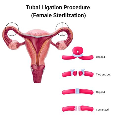 Tubal Ligation Procedure Midtown Nyc And Rego Park Queens Tubal