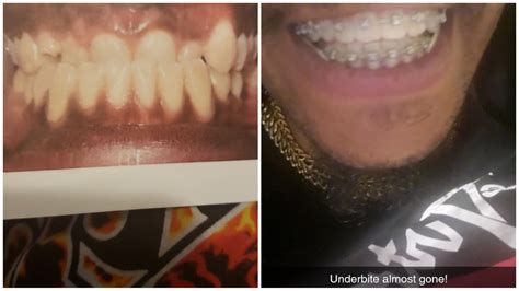 6 Month Braces Update For Underbite Rbraces