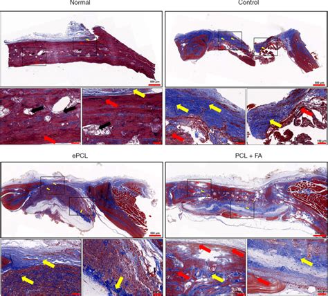 Electrospun Polycaprolactone Incorporated With Fluorapatite Nanoparticles Composite Scaffolds