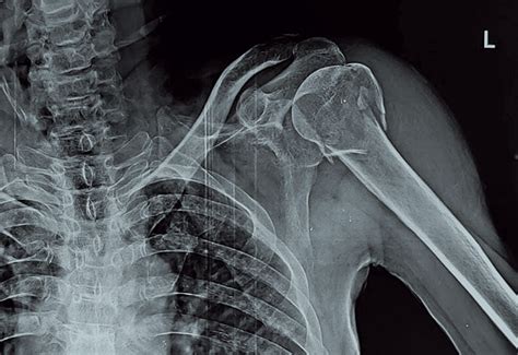 Proximal Humerus Fracture Total Orthopaedic Care Surgery