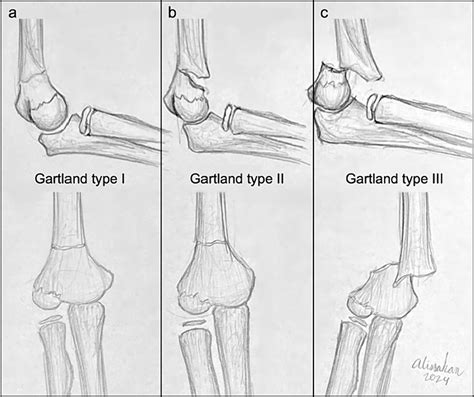 The Gartland Classification For Expediting Supracondylar Humerus