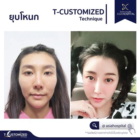 💥💥ตะลึงกับหน้าใหม่ เสริมจมูก เอเชียคลีนิก หมอทนงศักดิ์