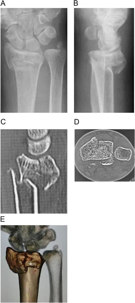 Distal Radius Fracture Complication Checklist And Score Sheet Printable Score Sheets