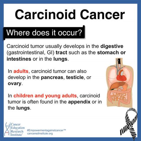Carcinoid Cancer