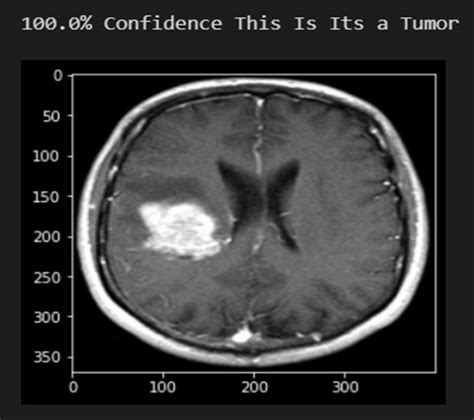 Github Jayanthreddy4 Brain Tumor Detection Using Deeplearning