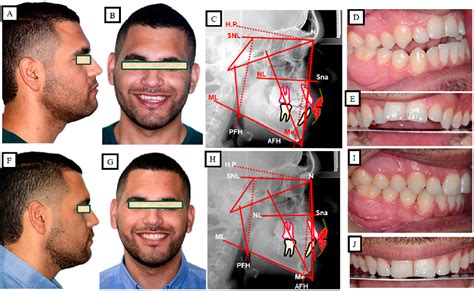 Figure 11 From Anterior Open Bite Malocclusion From Clinical Treatment Strategies Towards The