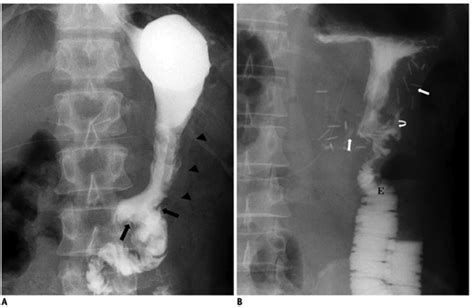 Normal Appearance Of A Patient Postmini Gastric Bypass On Upper Download Scientific Diagram