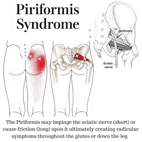 Knowledge3dart Piriformis Syndrome Can Occur In Both Shortened