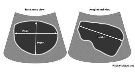 How To Measure Bladder Volume On Ultrasound Ultimate Guide Measuring