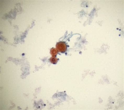 Update Cryptococcus Antigen Test Is Positive 40yr Old Chronic Cough
