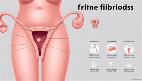 Norethindrone And Fibroid Reduction Insights And Tips Norethindrone And Fibroid Reduction Insights And Tips