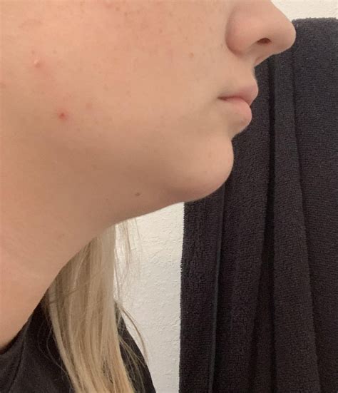 Masseter Botox Experience Rcosmeticsurgery