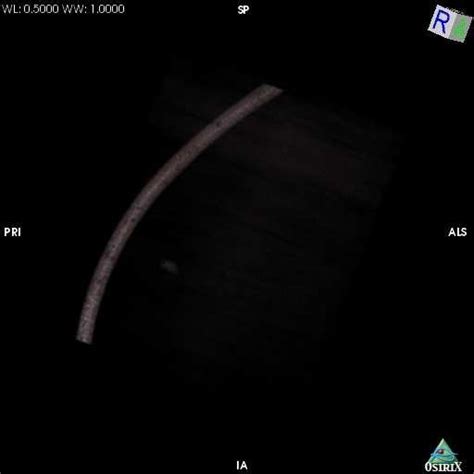 3d Volume Rendering Of The Subtracted Windowed Slices E 2i − E 3i −