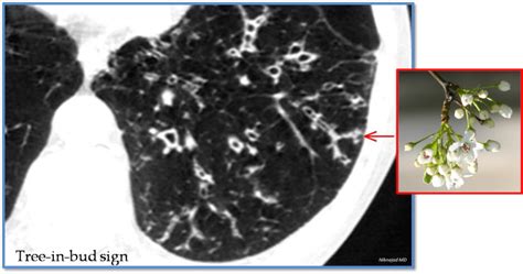 Tree In Bud Sign Radiology Signs Pathology
