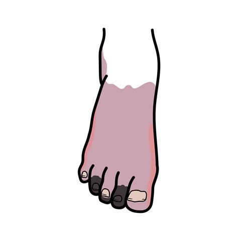 Approach To Upper Gastrointestinal Bleeding Causes Symptoms Melena And Treatment Armando