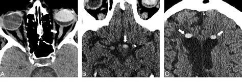 Figure 3 From Subretinal And Retrolaminar Migration Of Intraocular