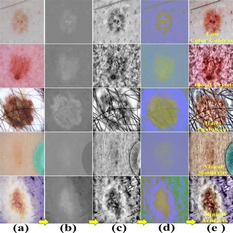 The Number Of Various Occlusions Inside The Isic 2018 Dataset