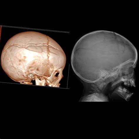 Xray Skull Fracture Tripod Fracture Radiology At St Vincents
