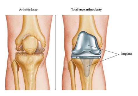 Obesity And Total Joint Arthroplasty Mayo Clinic