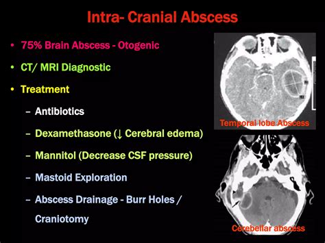 Complications Of Csom Ppt Ear Nose And Throat Conditions