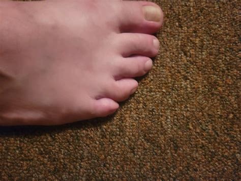 Weird Growth On Side Of Small Toe Rmedical