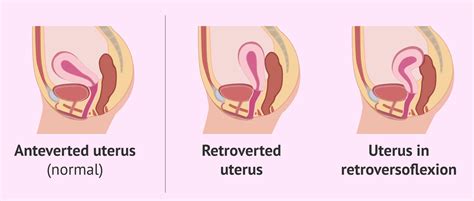 Different Posititions Of The Uterus