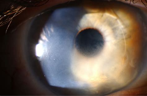 Moran Core Corneal Decompensation Secondary To Verisyse Lens Implantation