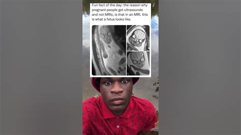 Fun Fact Of The Day The Reason Why Pregnant People Get Ultrasounds And Not Mris Is That In An