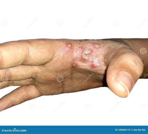 Erythema Hands
