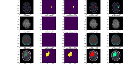 brain tumor segmentation and classification using resunet r deeplearning