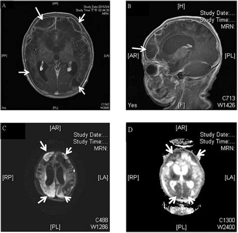 Bacterial Meningitis Brain Mri