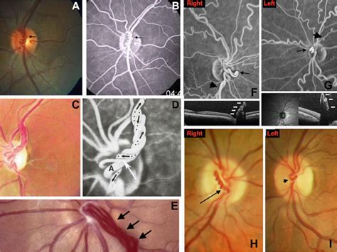 Prepapillary Vascular Loop A New Classification Pmc