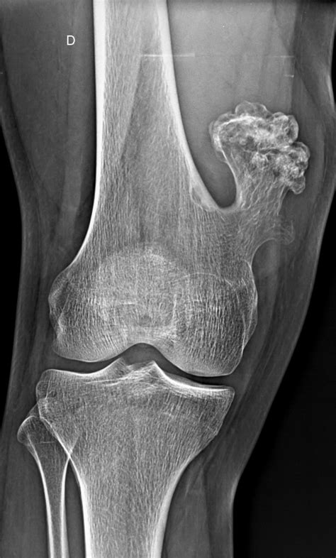 Osteochondroma Femur