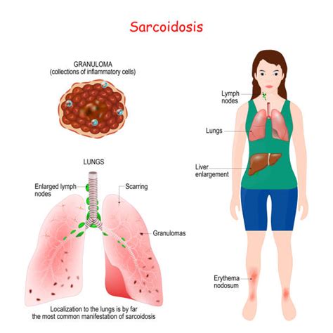 50 Lungs Sarcoidosis Stock Illustrations Royalty Free Vector Graphics