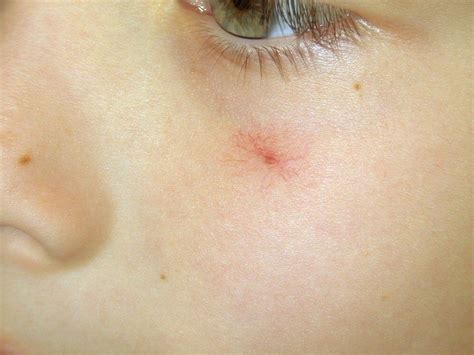 Spider Angioma Face Spider Angiomas Nzqpb