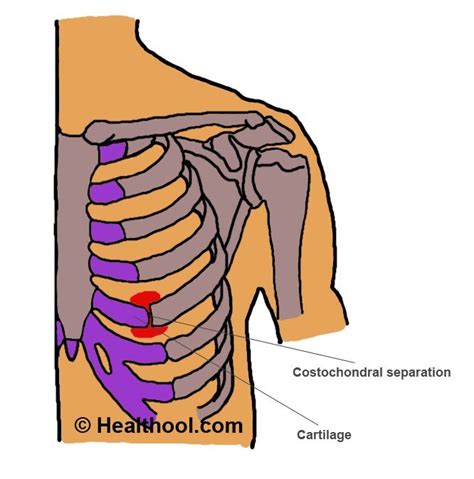 Costochondral Separation Symptoms Diagnosis Treatment
