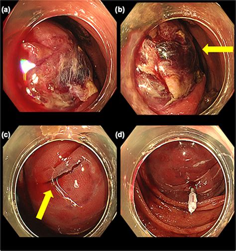 Large Submucosal Hematoma After Cold Snare Polypectomy For Colorectal