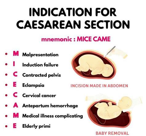 C Section Indications MEDizzy
