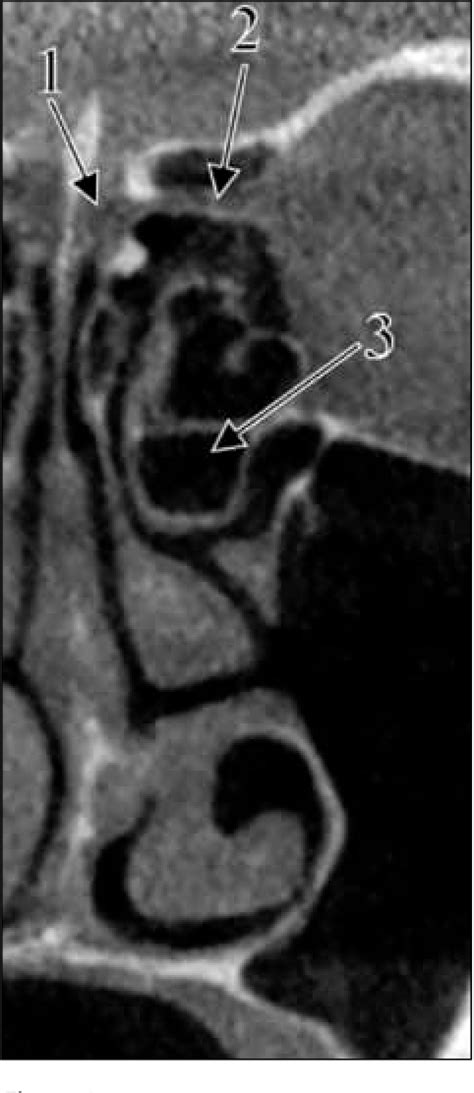 Ethmoidal Polyp Semantic Scholar