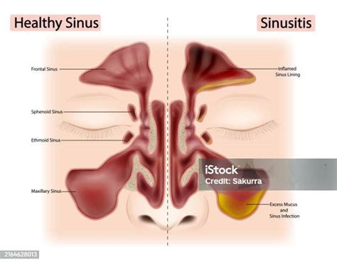 건강한 부비동 및 부비동염 또는 비부비동염 과도한 점액 및 부비동 감염 코에 대한 스톡 벡터 아트 및 기타 이미지 코 해부학 건강관리와 의술 Istock