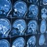 Can A Concussion Cause Memory Loss Brain Injury Law Of Seattle