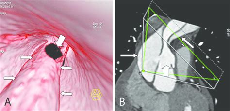 Intimointimal Intussusception On Vie And Mpr Vie A Shows The True Download Scientific