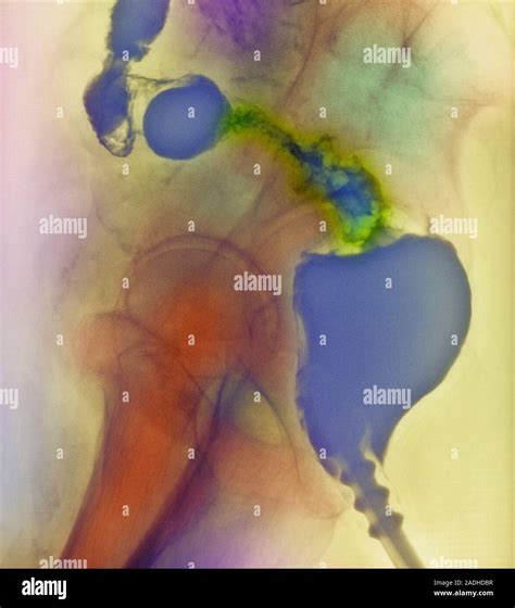 Colon Cancer Coloured Barium X Ray Showing Cancer Blue Yellow Upper Right Of The Colon Part