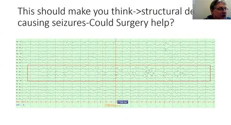 Generalized Seizure Eeg