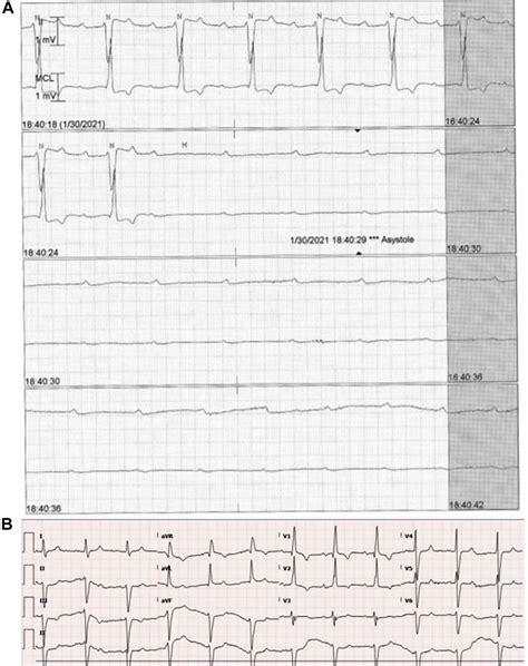 Complete Heart Block Without Ventricular Escape Secondary To Hyperkalemia Induced By Herbal Tea