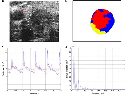 Figure 1 From Thyroid Nodule Classification Using Ultrasound Elastography Via Linear