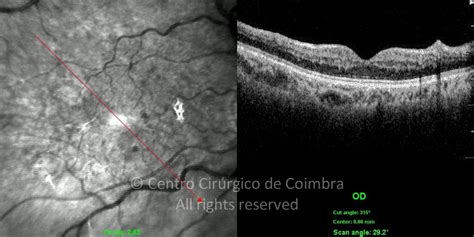 Caso Clínico 3 Atlas Rl Eye