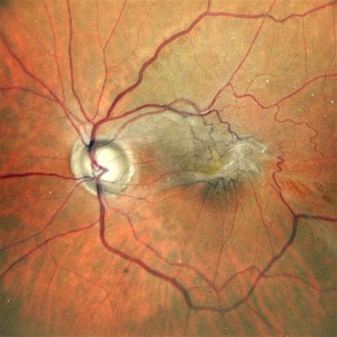 Epiretinal Membrane Causing Macular Pucker Retina Image Bank