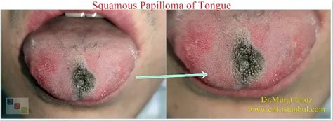 Oral Human Papillomavirus Hpv Infection Symptoms Diagnosis Prevention And Treatment