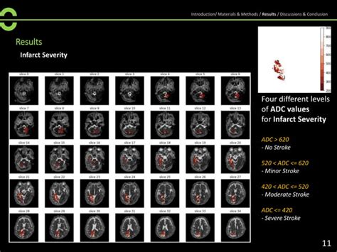 Deep Learning Based Fully Automated Detection And Quantification Of Acute Infarcts Ppt